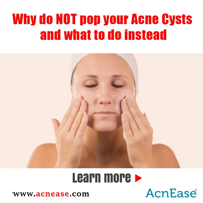 Why do NOT pop your Acne Cysts and what to do instead | Blog