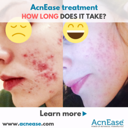AcnEase all natural acne treatment for adult and teen acne